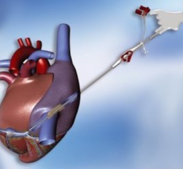 CARDIAC CANNULA - Thailand Medical News