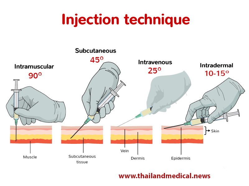 Intravenous Injection Sites